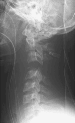 Case 2 X-rays on admission - BGD3 Fracture Healing Practical Class